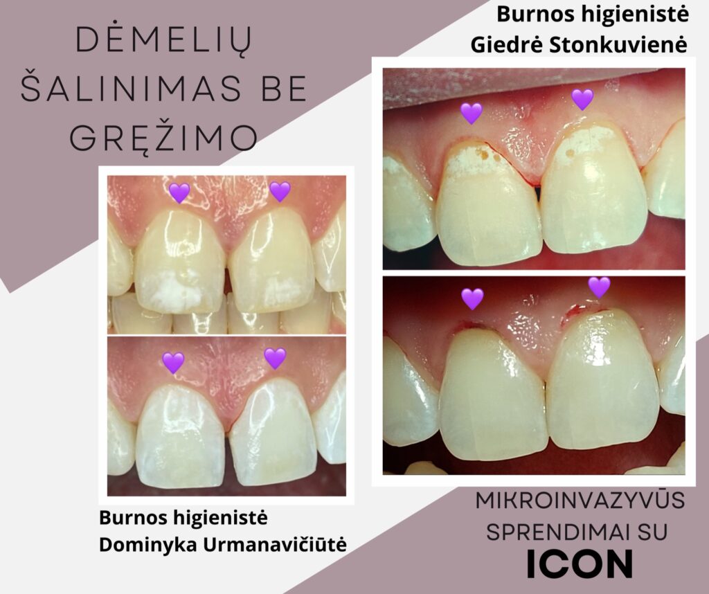 Dantų dėmių šalinimas ICON sistema – eArmedika